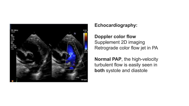 Patent Ductus Arteriosus (PDA) Echocardiographic Assessment: Anatomy ...