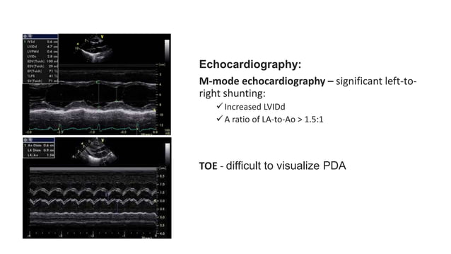 Patent Ductus Arteriosus (PDA) Echocardiographic Assessment: Anatomy ...