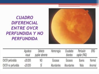 Obstrucción de la vena central de la retina. Quezada | PPTX
