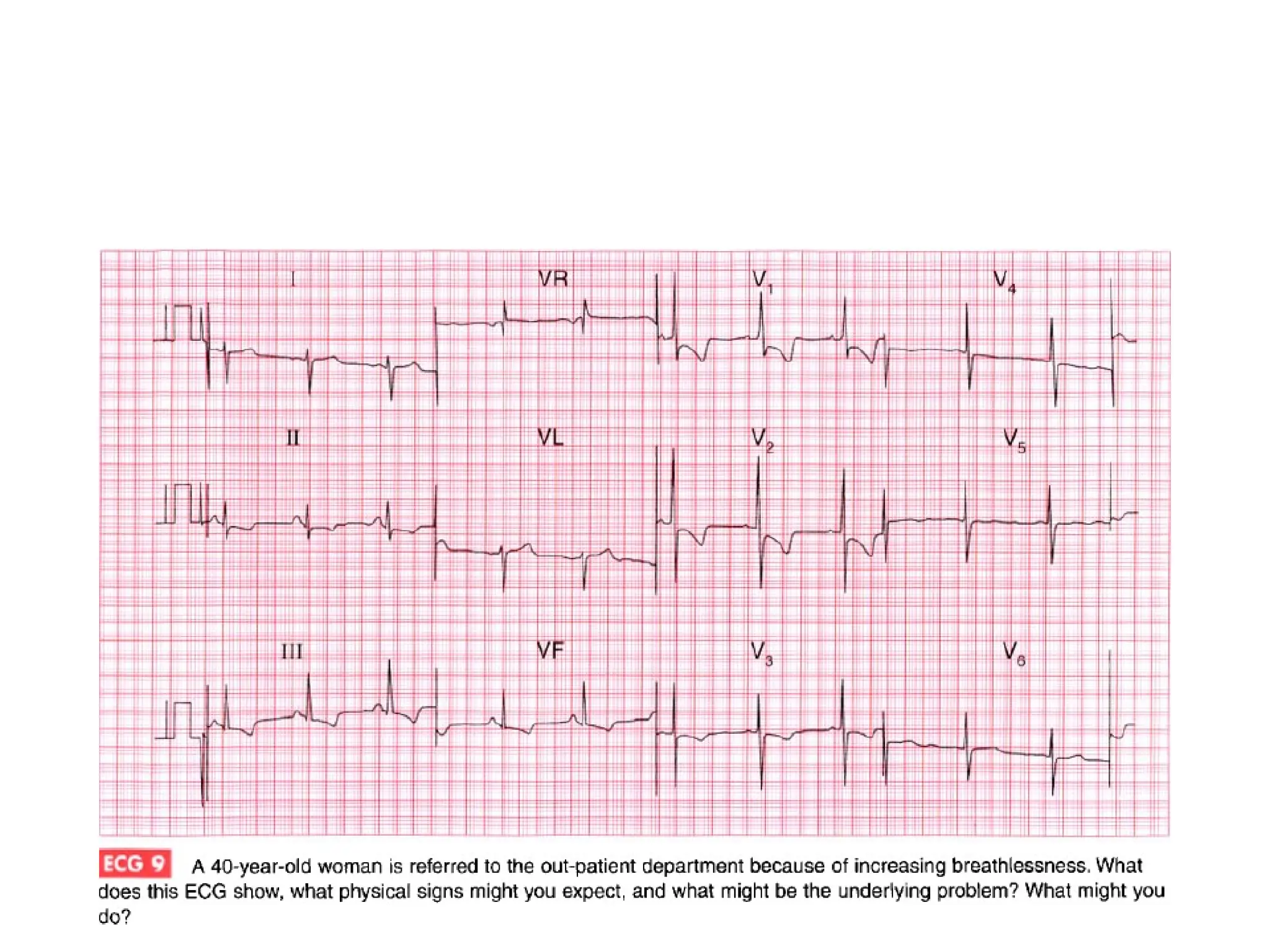 150 ECG exercises partI150 ECG exercises partI150 ECG exercises partI | PPT