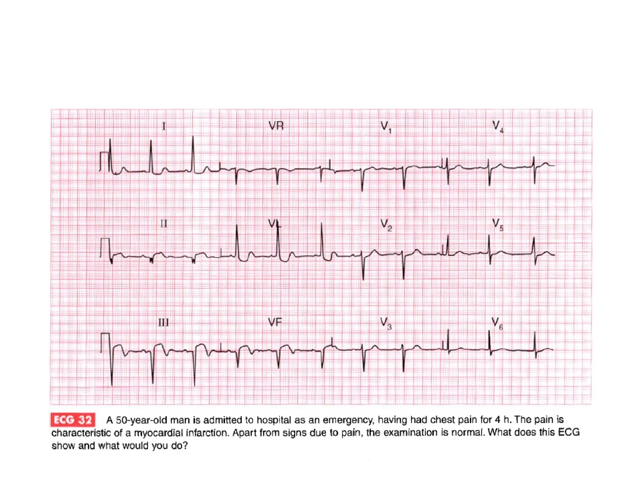 150 ECG exercises partI150 ECG exercises partI150 ECG exercises partI | PPT