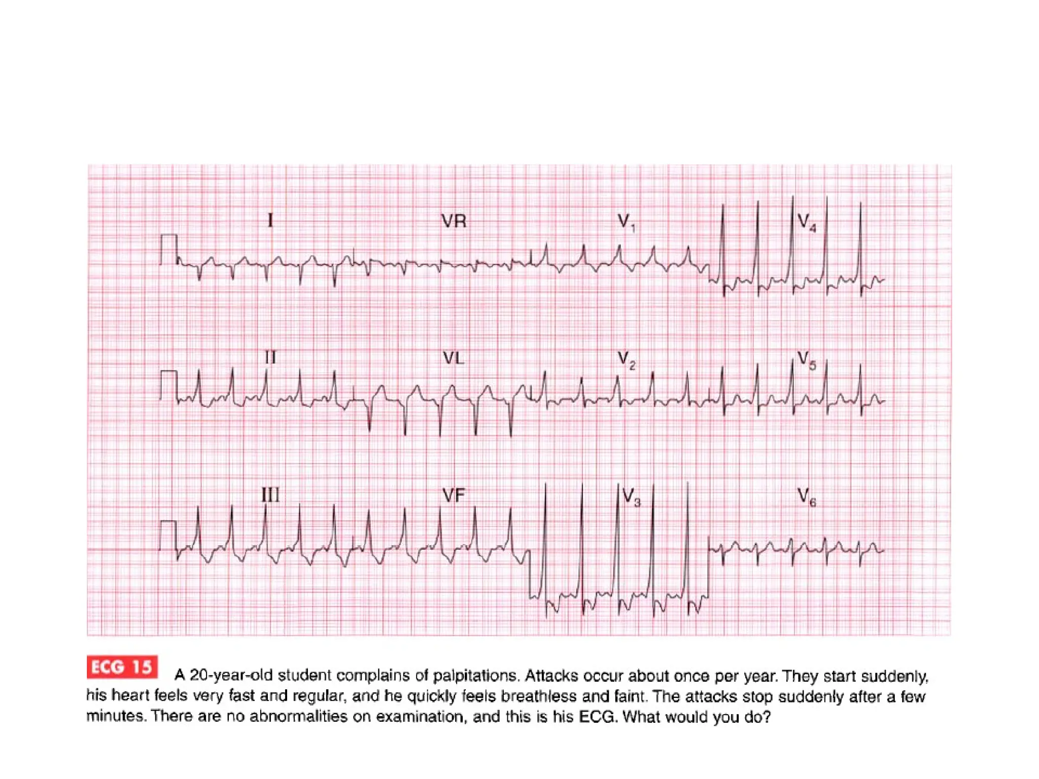 150 ECG exercises partI150 ECG exercises partI150 ECG exercises partI | PPT