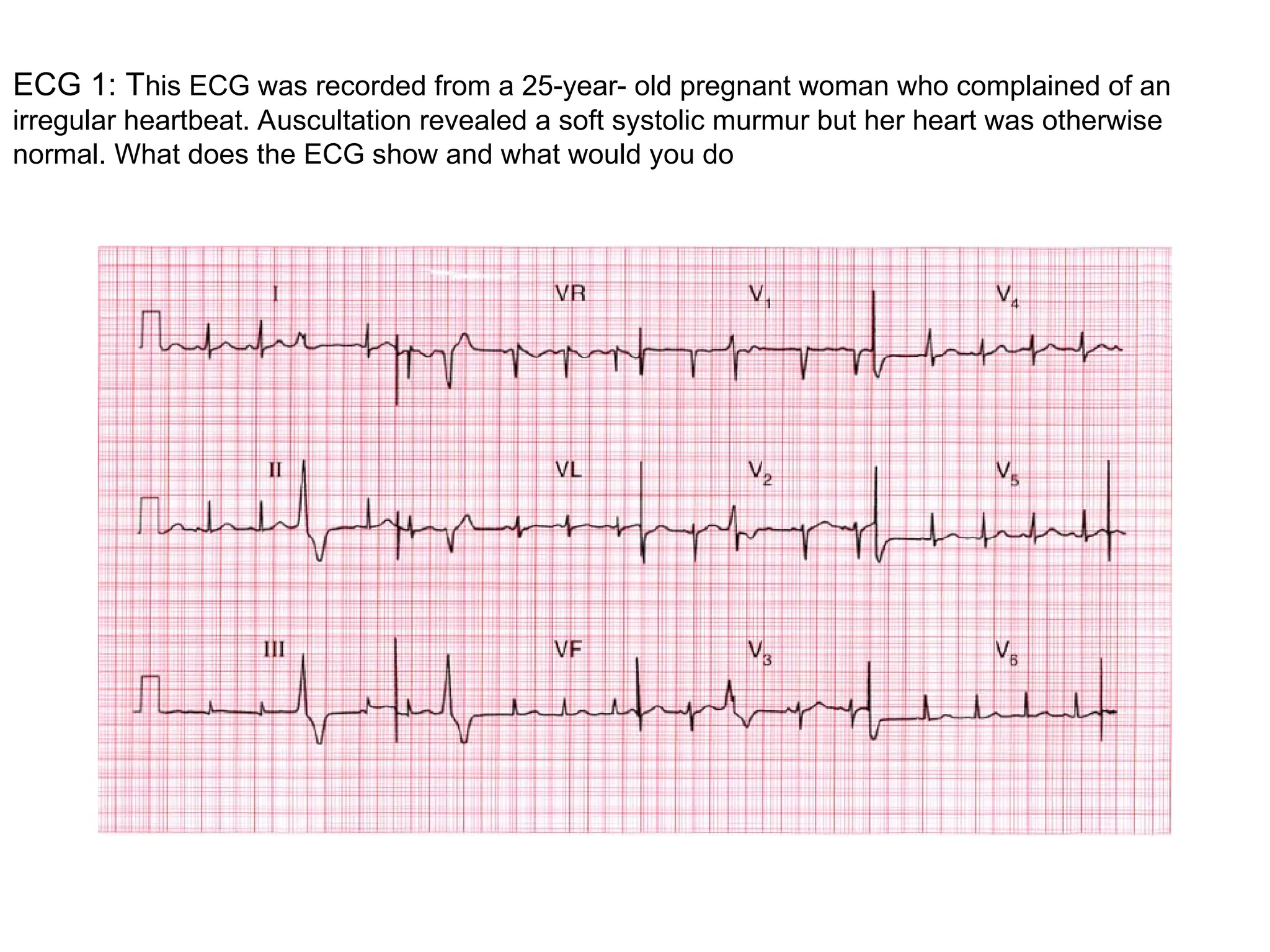 150 ECG exercises partI150 ECG exercises partI150 ECG exercises partI | PPT