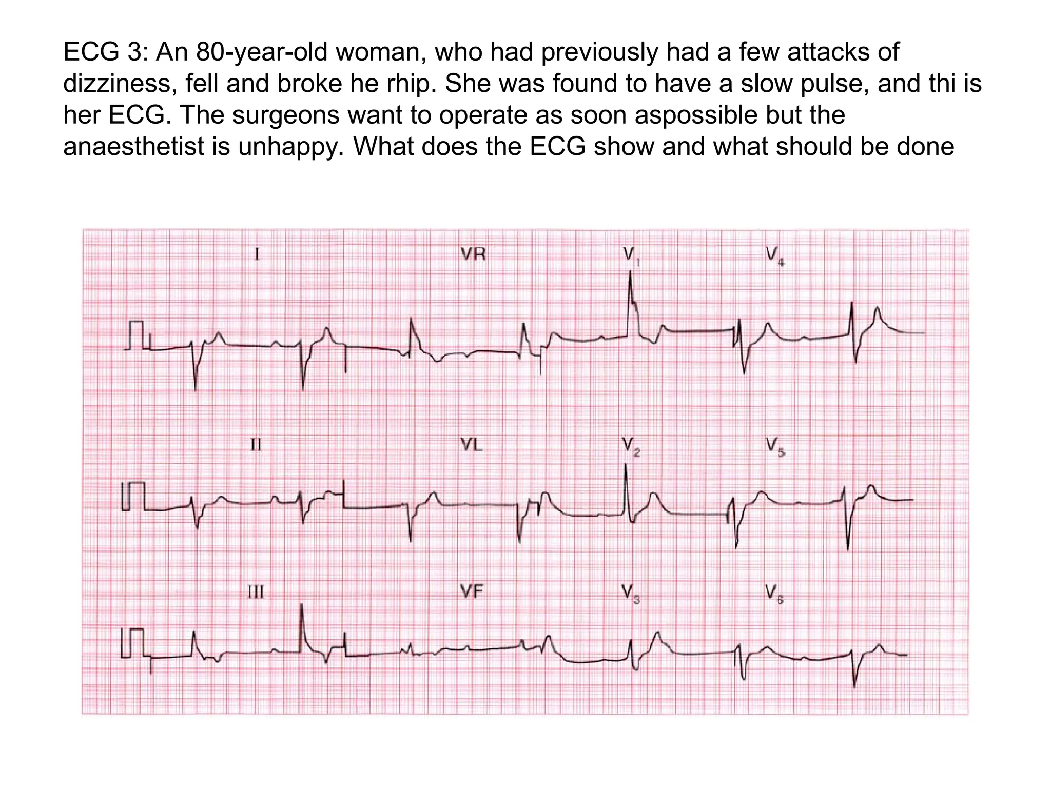 150 ECG exercises partI150 ECG exercises partI150 ECG exercises partI | PPT