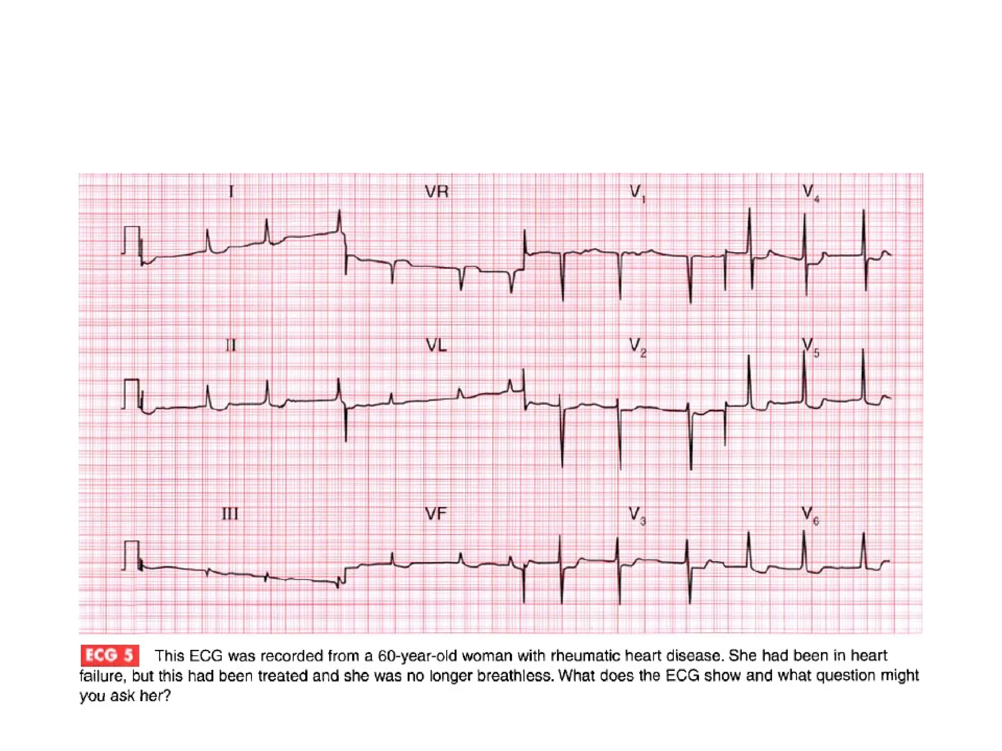 150 ECG exercises partI150 ECG exercises partI150 ECG exercises partI | PPT