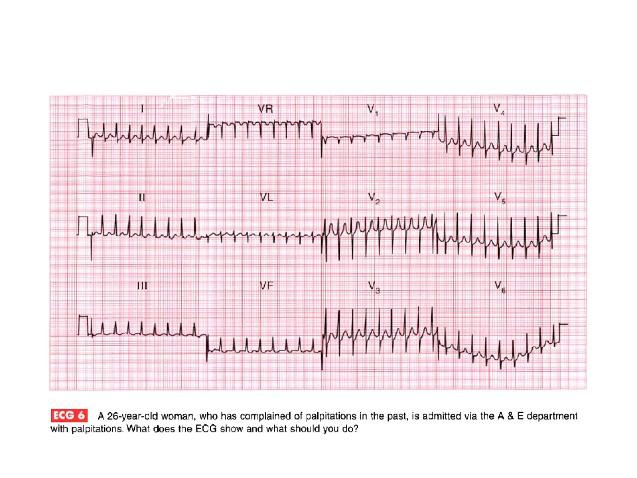 150 ECG exercises partI150 ECG exercises partI150 ECG exercises partI | PPT