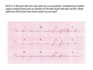150 ECG exercises partI150 ECG exercises partI150 ECG exercises partI | PPT