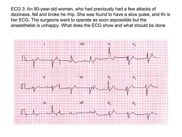 150 ECG exercises partI150 ECG exercises partI150 ECG exercises partI | PPT