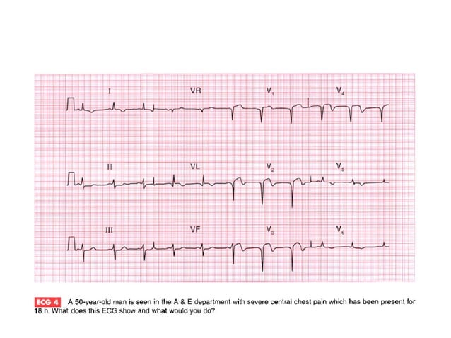 150 ECG exercises partI150 ECG exercises partI150 ECG exercises partI | PPT