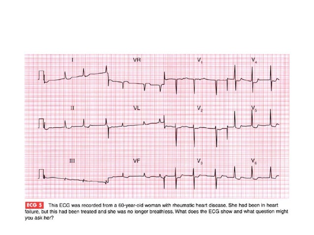 150 ECG exercises partI150 ECG exercises partI150 ECG exercises partI | PPT