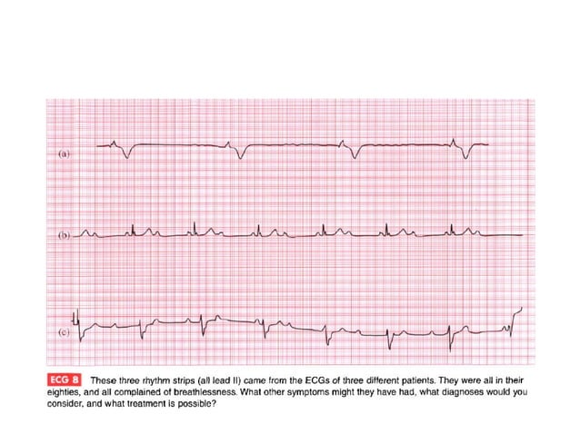 150 ECG exercises partI150 ECG exercises partI150 ECG exercises partI | PPT