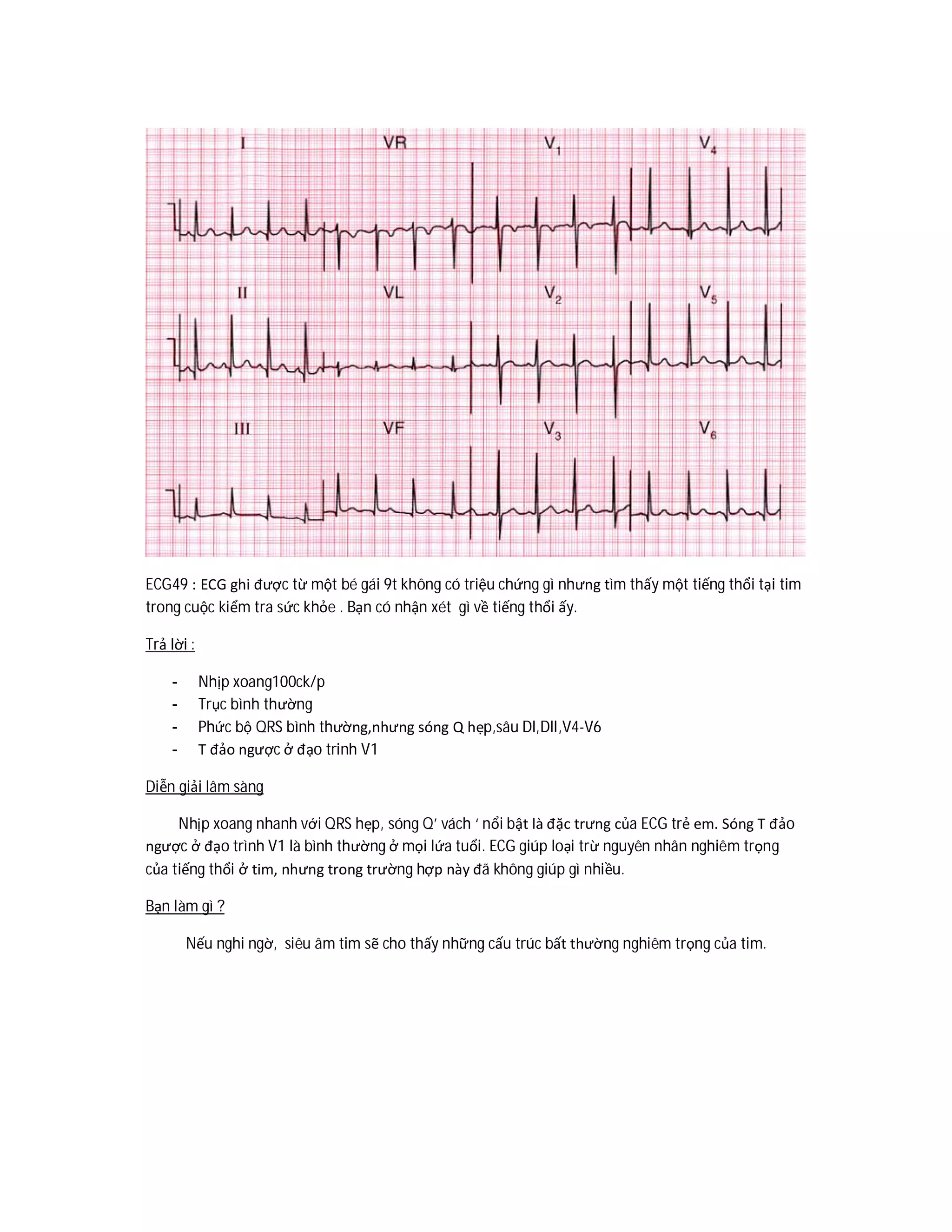 150 vấn đề ECG | PDF