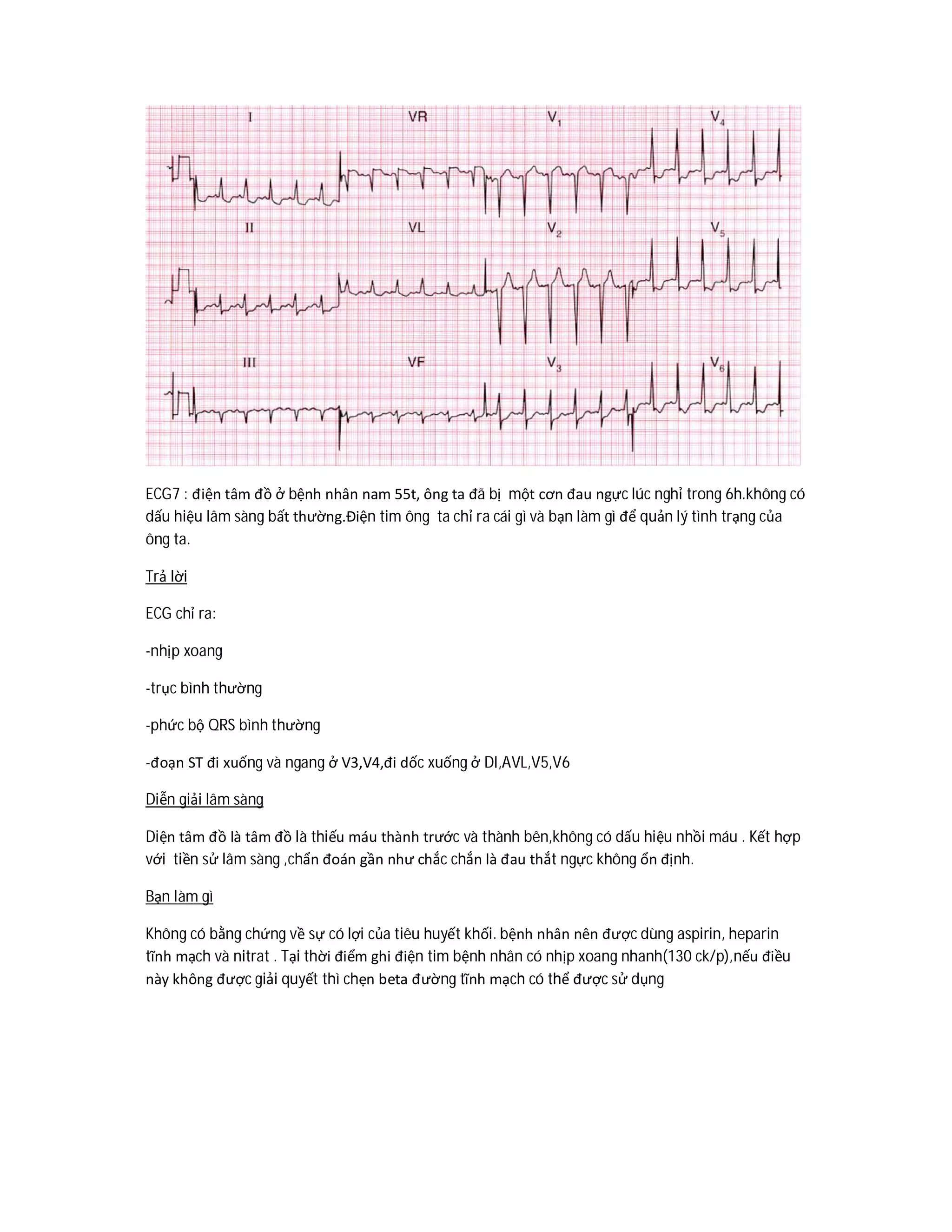 150 vấn đề ECG | PDF