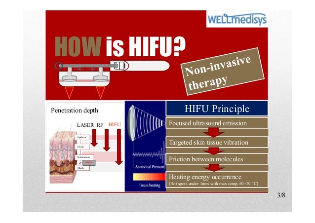 Ucare Skin Therapy HIFU