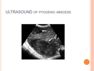 liver abscess | PPTX