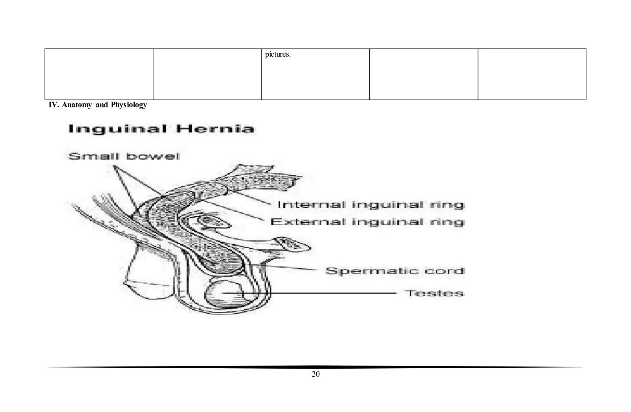 153294346 case-study-of-indirect-inguinal-hernia-r | DOCX