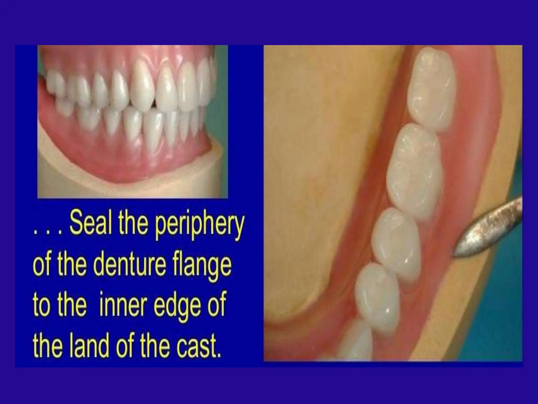 Processing of Complete denture prosthodontics.pptx