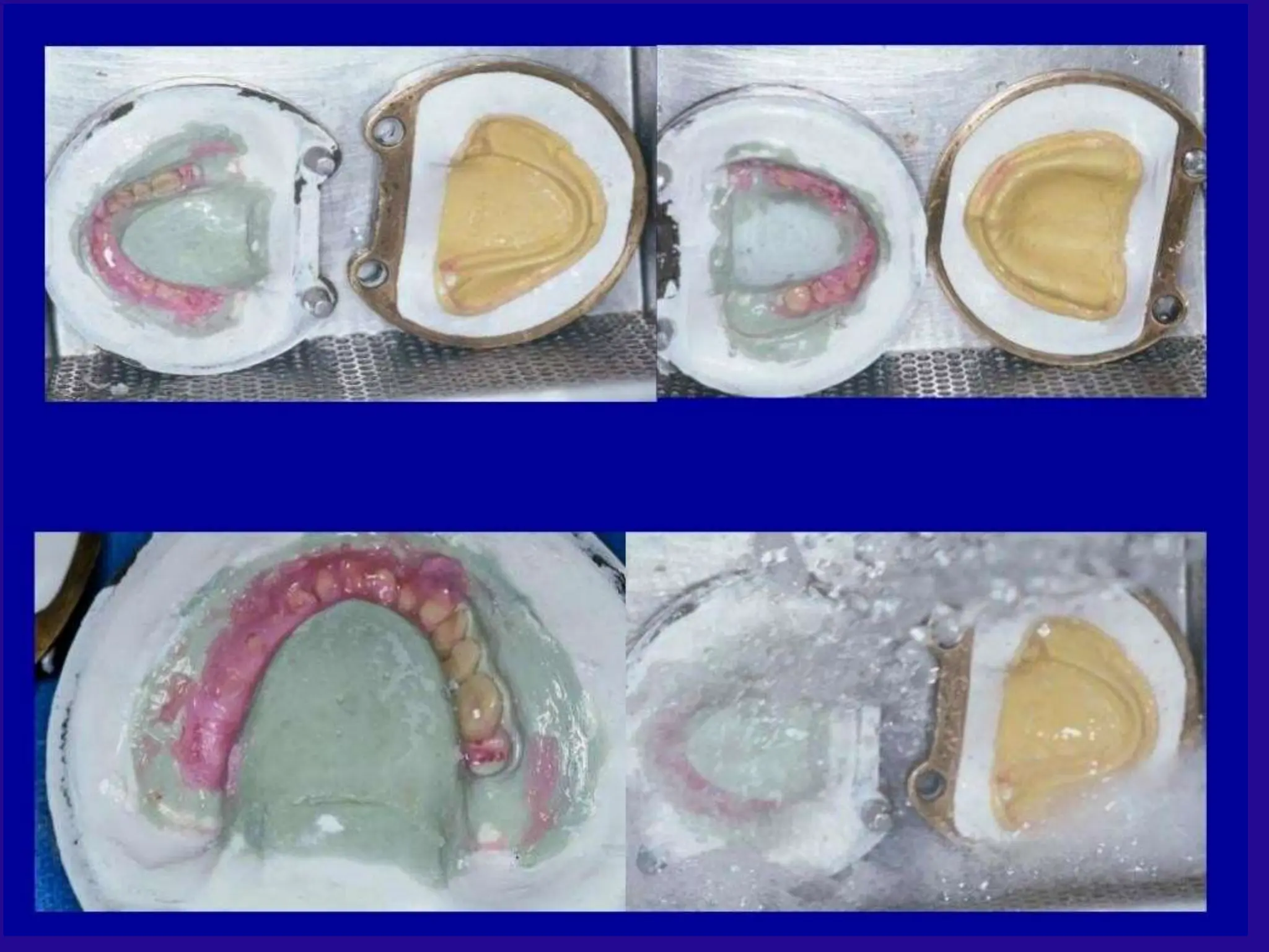Processing of Complete denture prosthodontics.pptx