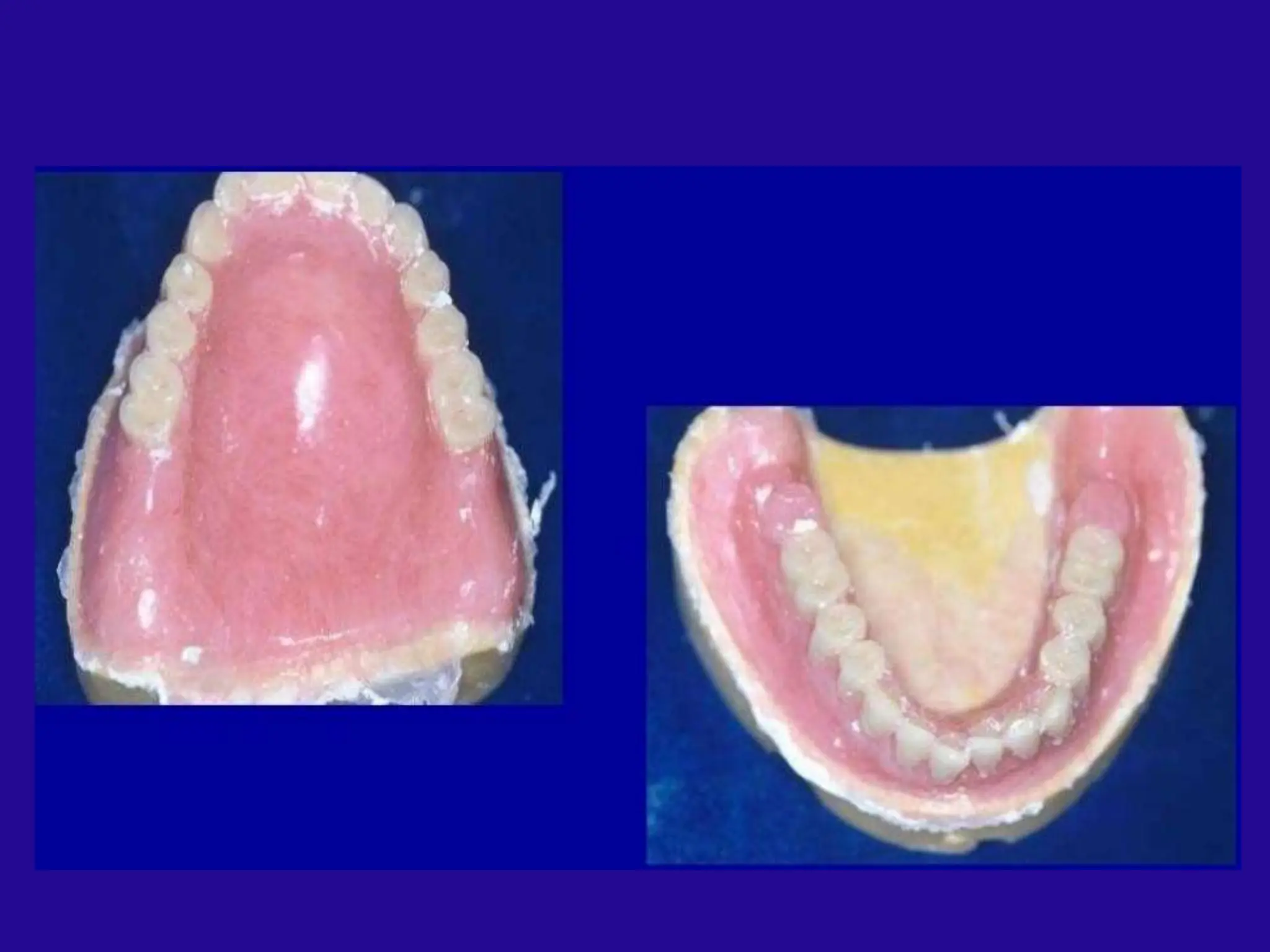 Processing of Complete denture prosthodontics.pptx