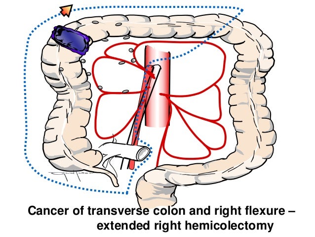 Standardization of CME for Transverse Colon Cancer