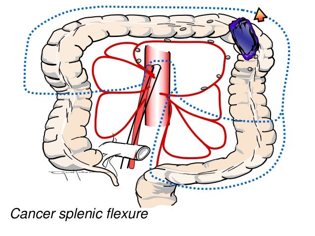 Standardization of CME for Transverse Colon Cancer