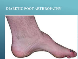 Diabetic foot | PPTX