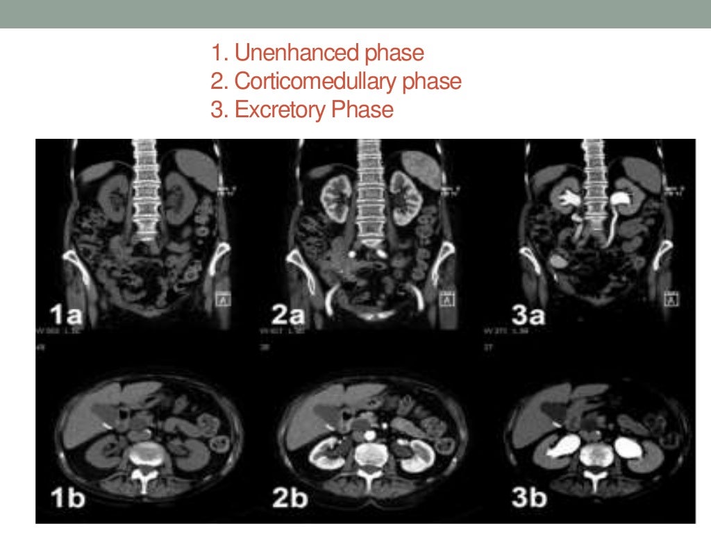 CT urography
