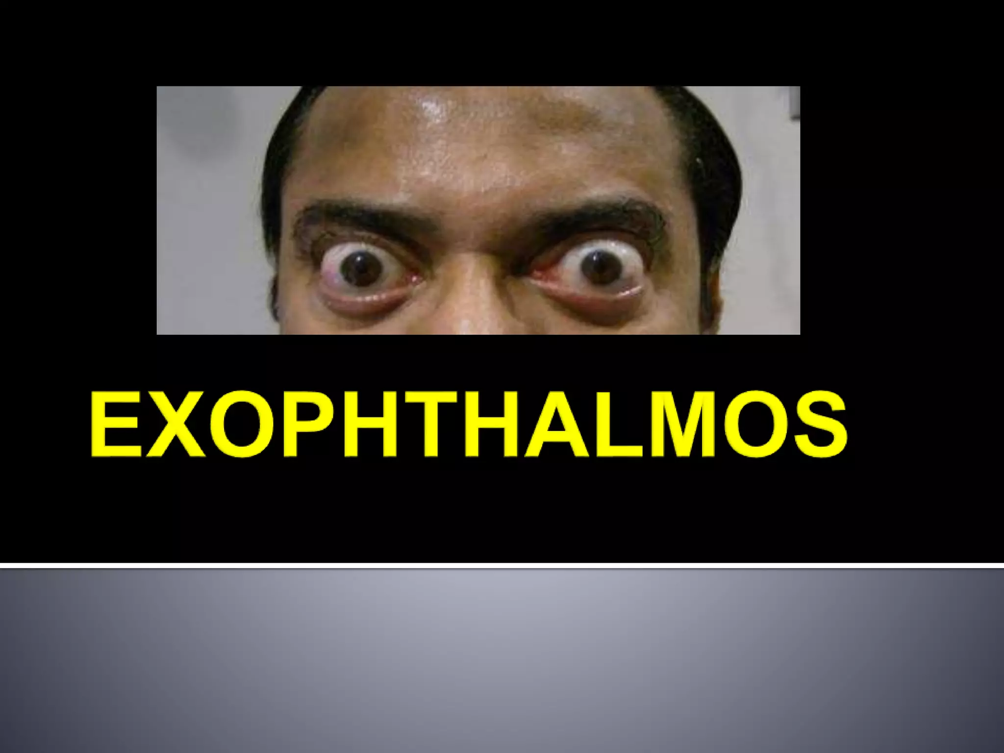 Exophthalmos | PPTX