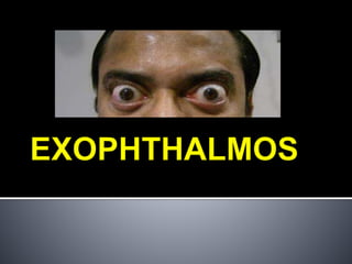 Exophthalmos | PPTX