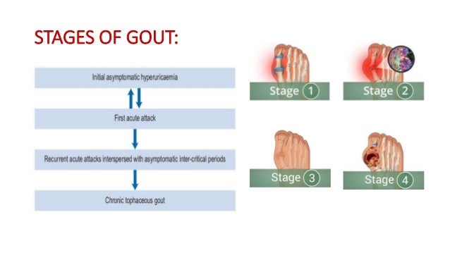Pathophysiology and clinical management of gouty arthritis