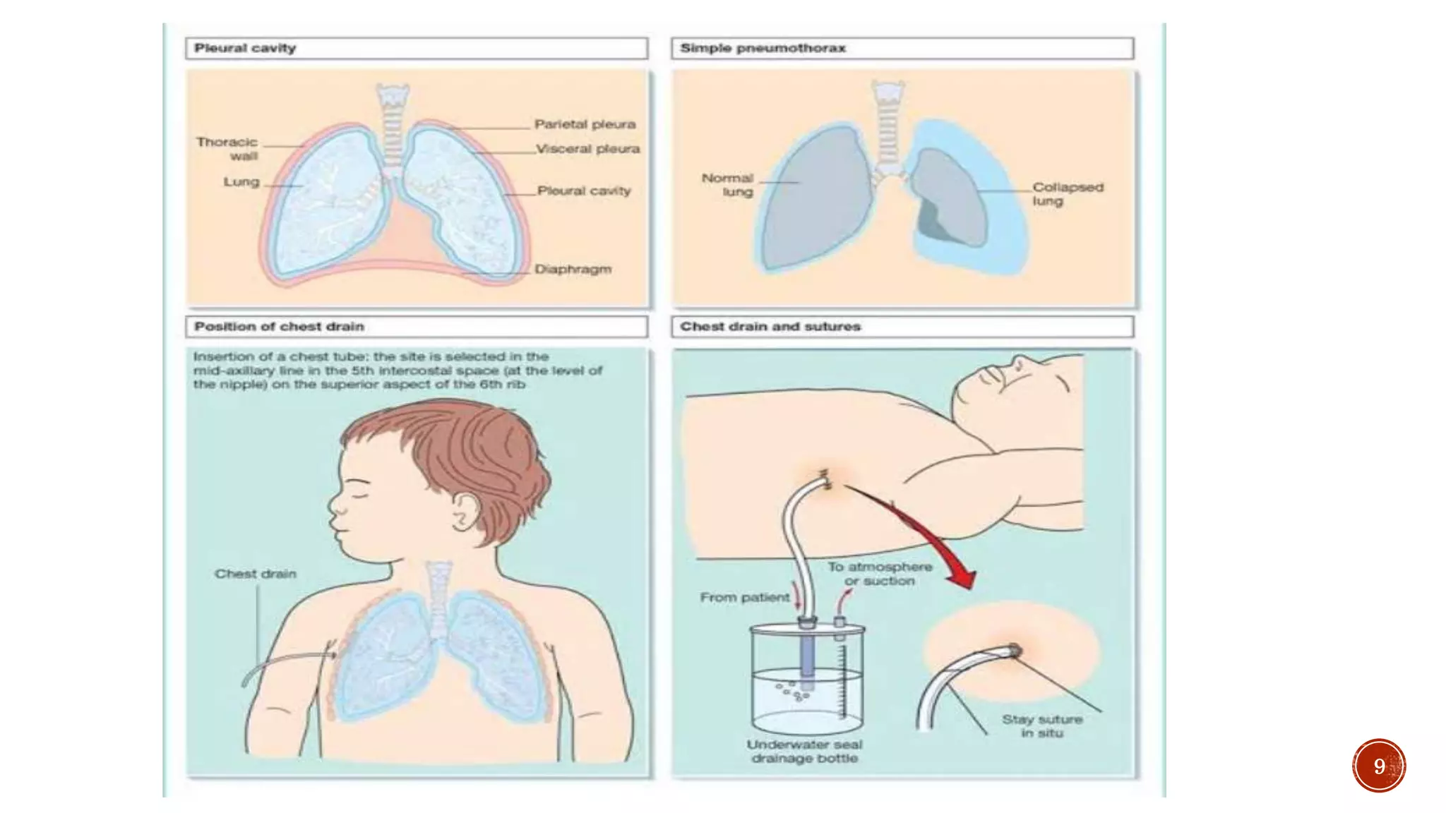 case presentation on hydropneumothorax | PPTX