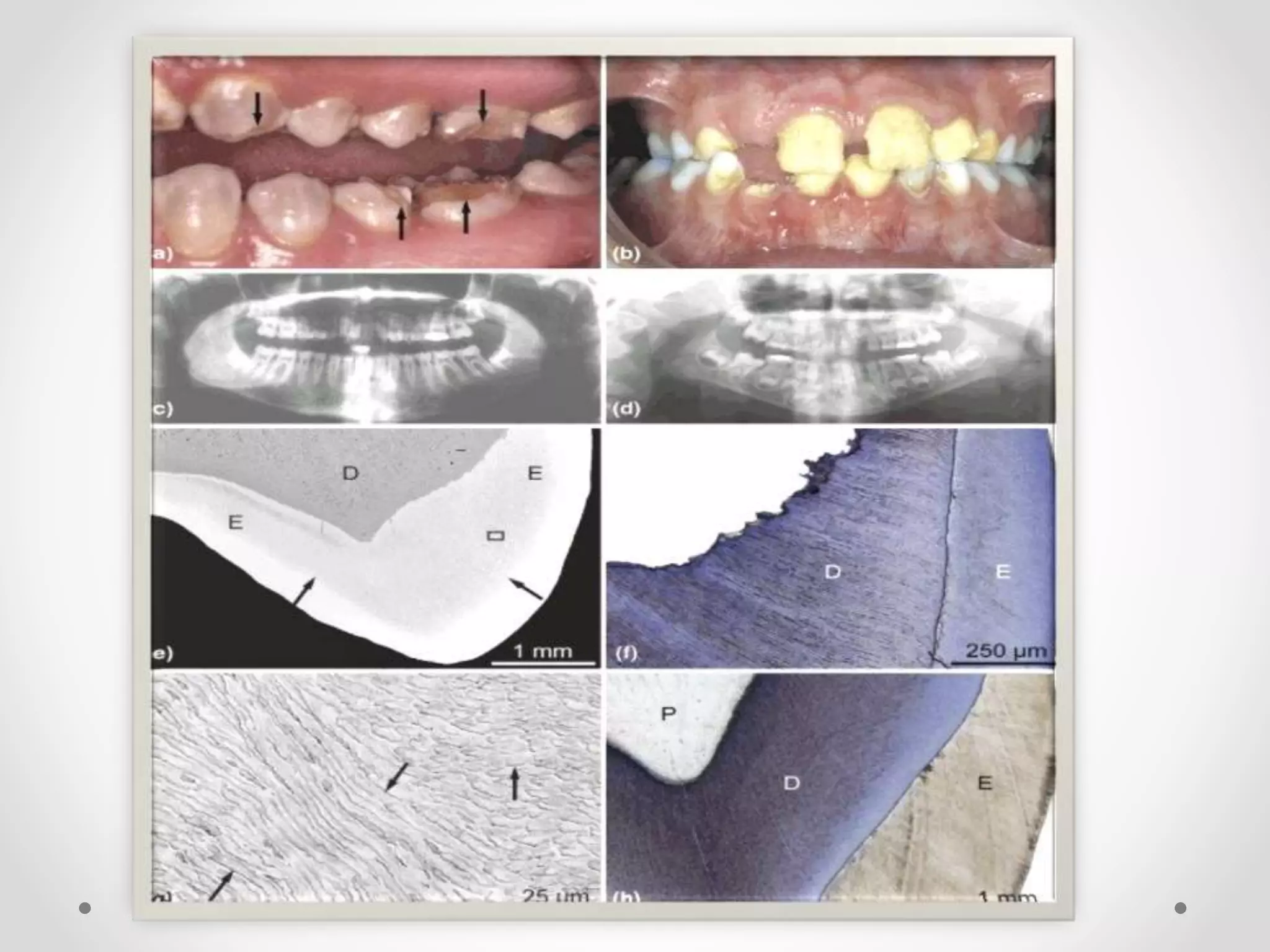structural anomalies of teeth | PPTX