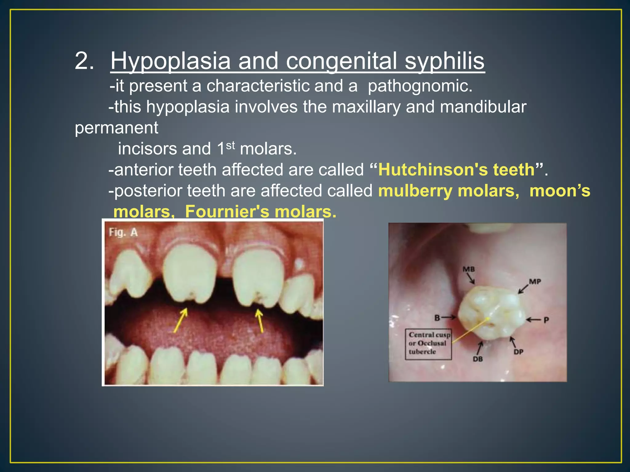 structural anomalies of teeth | PPTX
