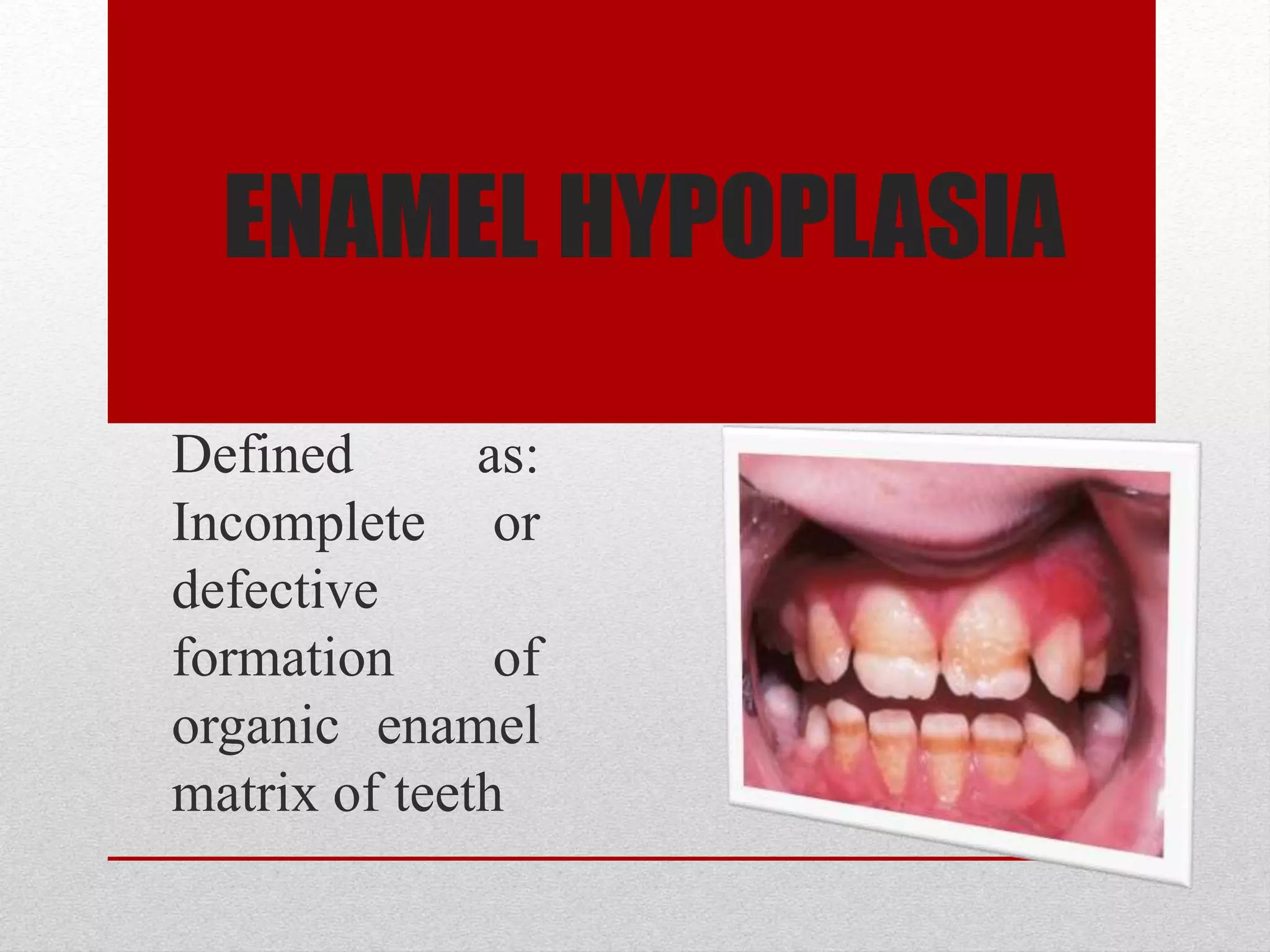 structural anomalies of teeth | PPTX
