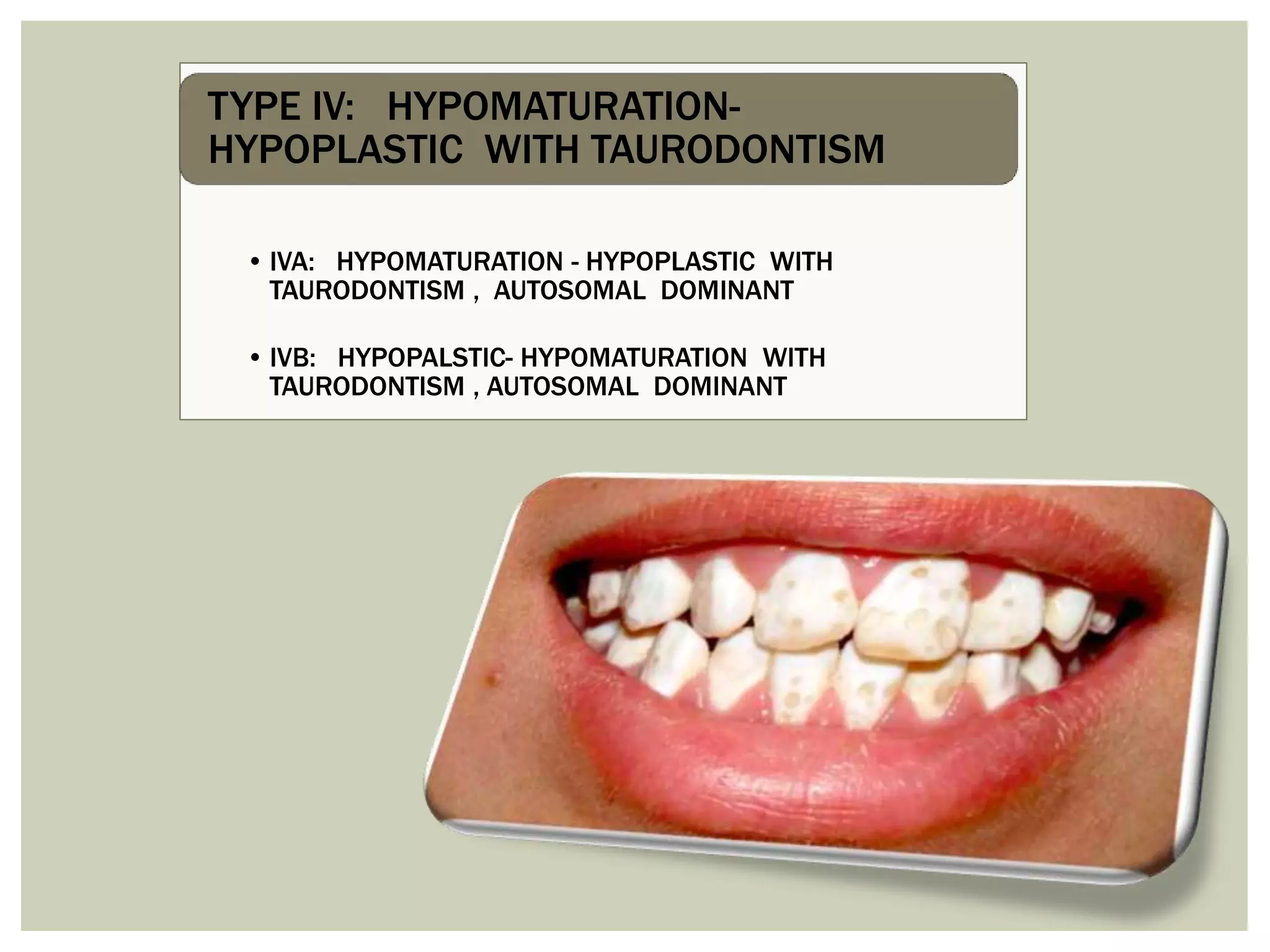structural anomalies of teeth | PPTX