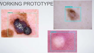 Ghaziabad, India - Early Detection of Various Types of Skin Cancer ...