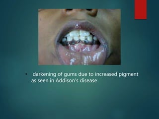 addison's disease ppt by ankita patel | PPTX