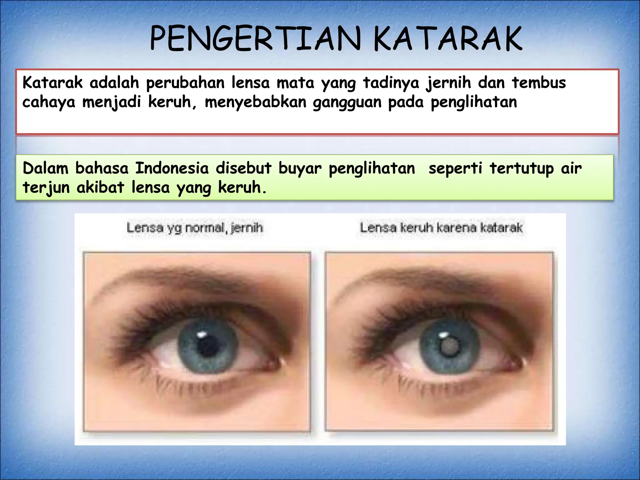158679843-Penyuluhan-Katarak-Koass-Mata.ppt