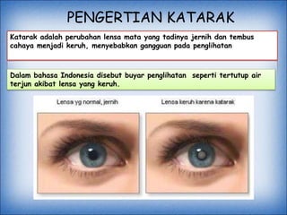 158679843-Penyuluhan-Katarak-Koass-Mata.ppt