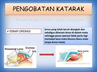 158679843-Penyuluhan-Katarak-Koass-Mata.ppt