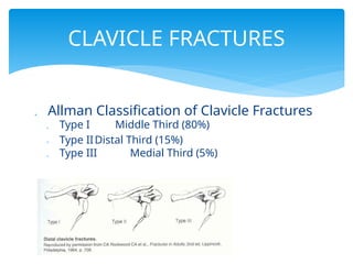 fractures-of-upper-extrimity-copy.pptx.. | PPT | Free Download