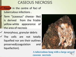 Caseous Necrosis Gross