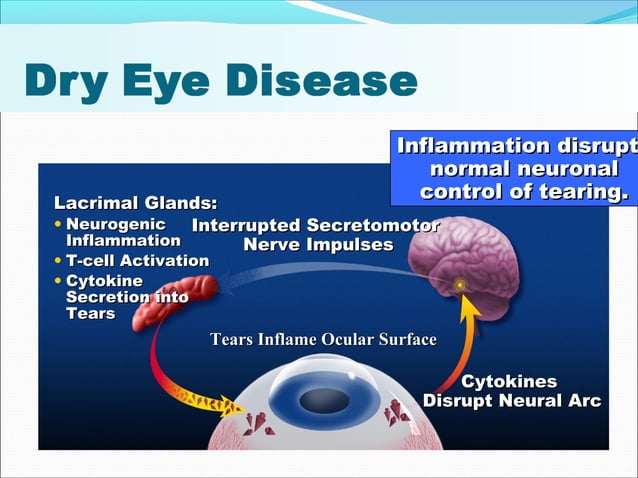 dry eye | PPT | Eye and Vision Conditions | Diseases and Conditions