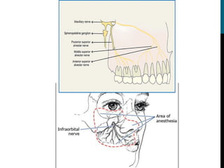 INFRA ORBITAL NERVE BLOCK Oral surgery presentation | PPTX