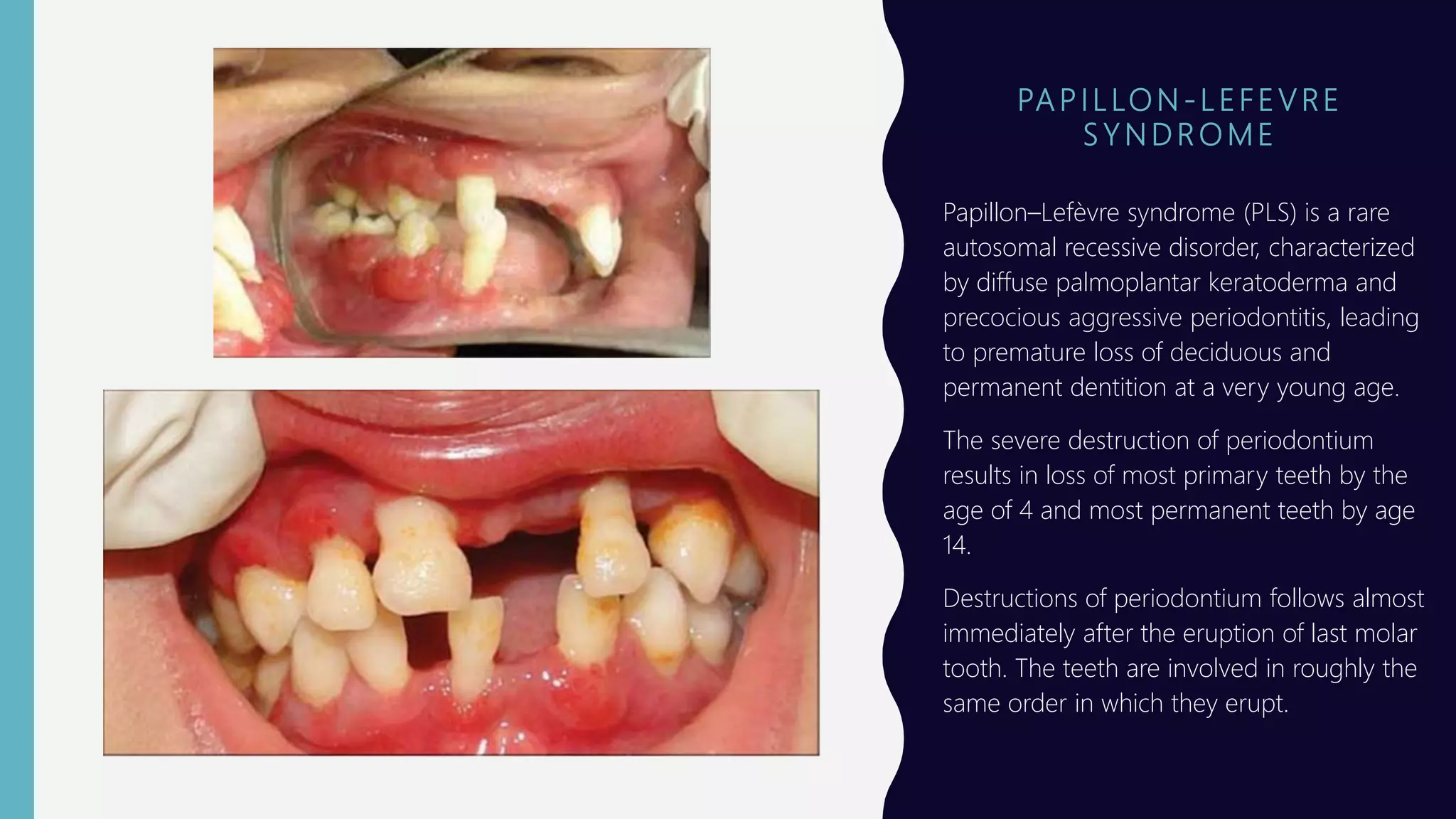 prosthetic tratment of pediatric patient | PPTX