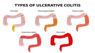 Indications of surgery in ULCERATIVE COLITIS.pptx