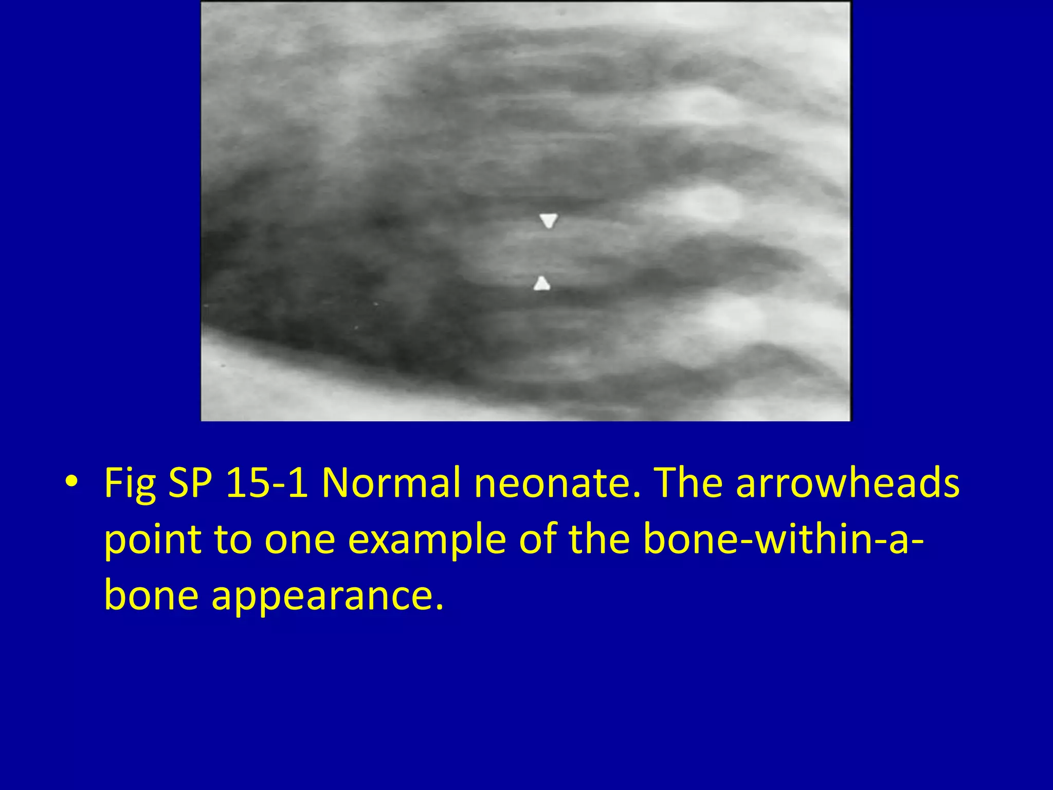 15 bone within-a-bone appearance | PPT