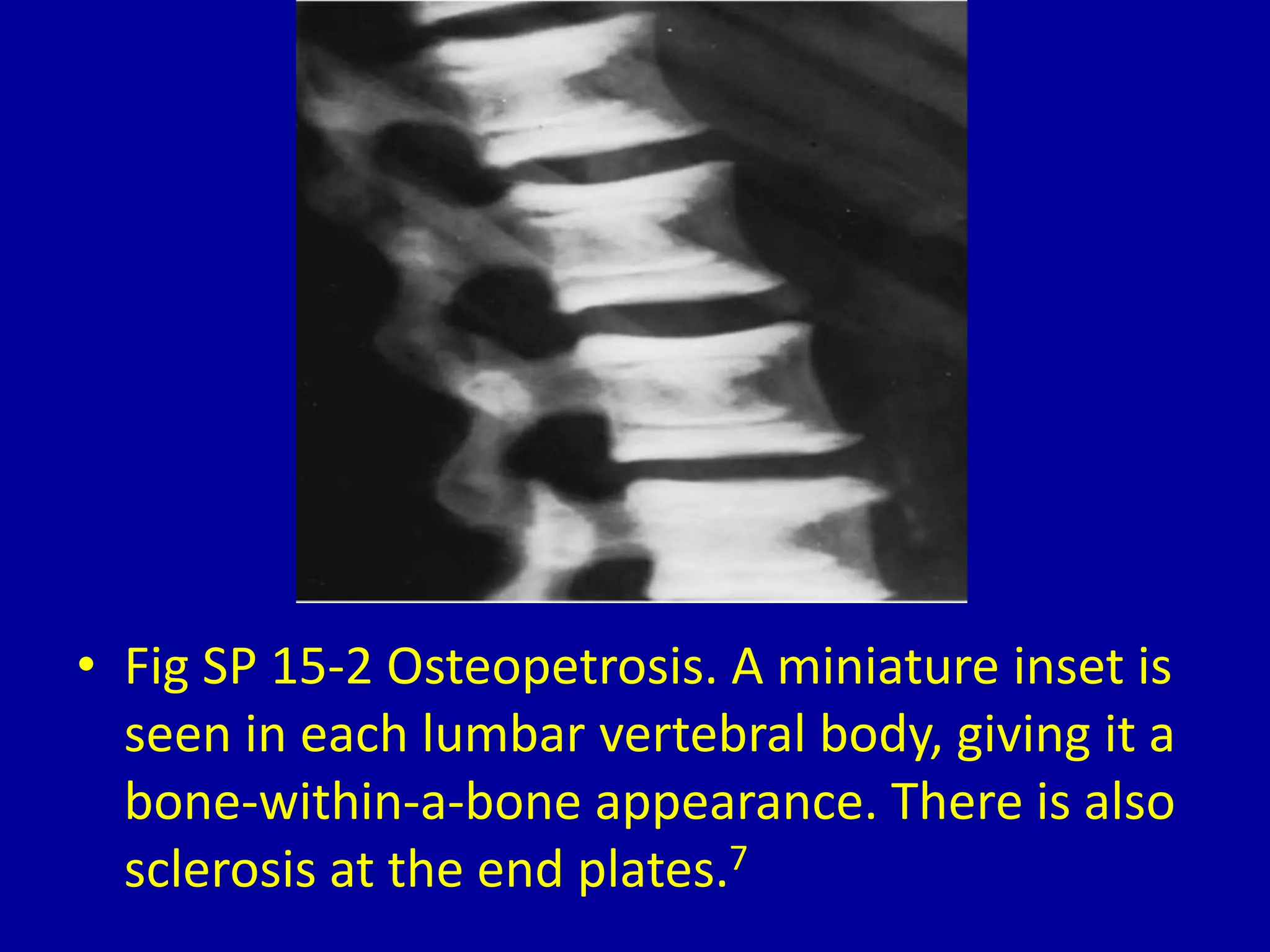 15 bone within-a-bone appearance | PPTX