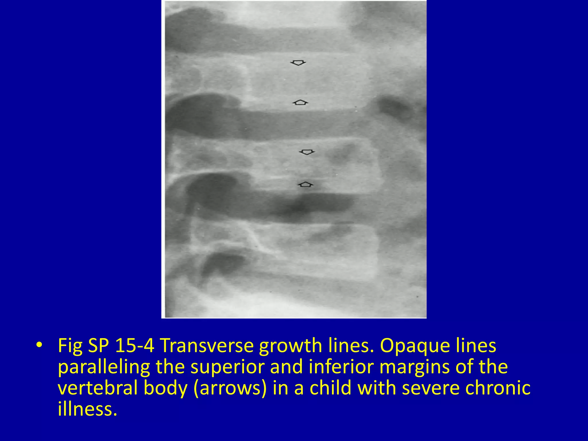 15 bone within-a-bone appearance | PPT