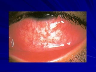 15Conjuntivitis bacteriana, viral y alergica.ppt